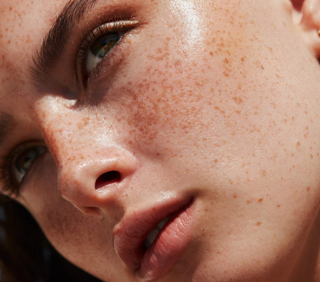 Profhilo Skin Booster - Dr Bonny